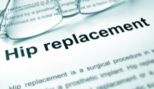 What happens when a hip replacement fails? » Nash and Franciskato Law Firm